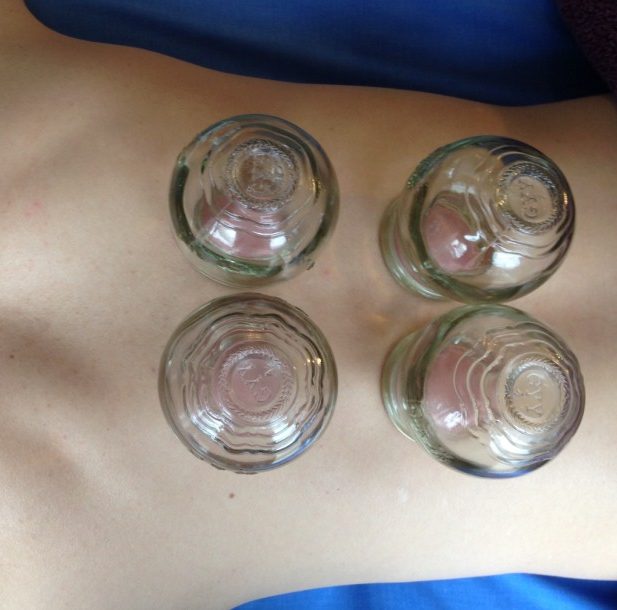 Geelong Cupping & Moxibustion - Geelong Chinese Medicine Clinic